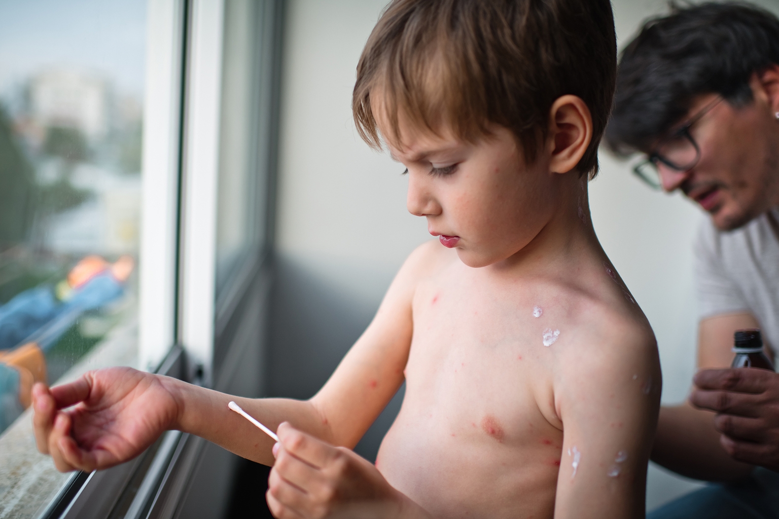 Vesirokko lapsella ja vauvalla | Mehiläinen